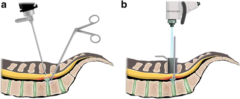 Clinical comparison of unilateral biportal endoscopic technique versus ...