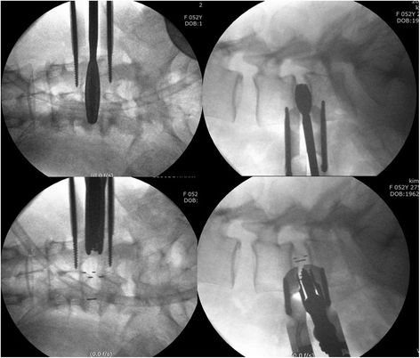 Outcomes of oblique lateral interbody fusion for degenerative lumbar ...