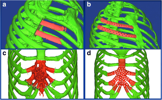Chest-wall reconstruction with a customized titanium-alloy prosthesis ...