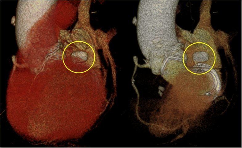 To repair or not to repair: a case report of atrioventricular groove ...