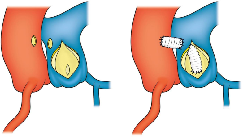 Reconstruction of anomalous left coronary artery from pulmonary artery ...