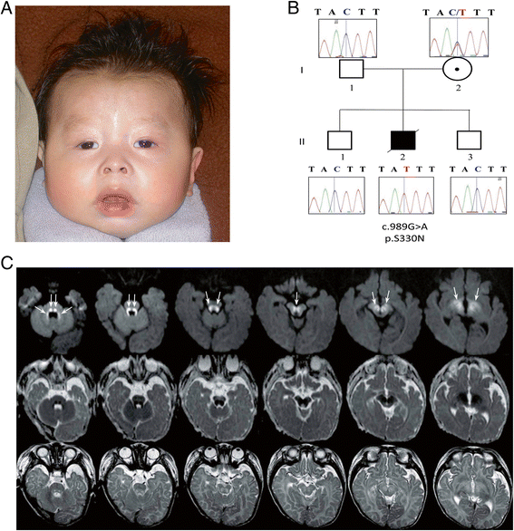 The genotypic and phenotypic spectrum of PIGA deficiency | Orphanet ...