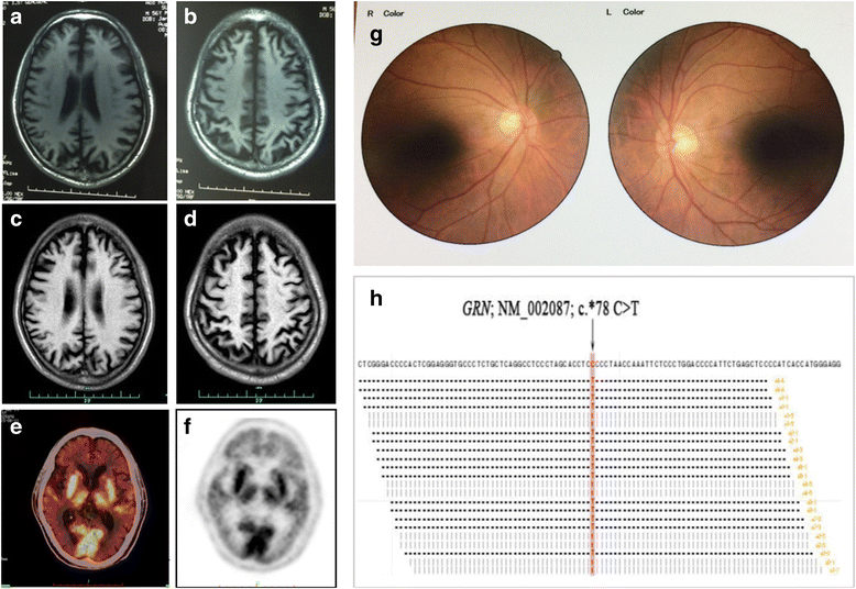 Posterior cortical atrophy as a primary clinical phenotype of ...
