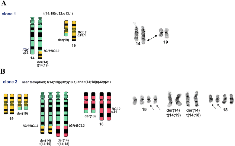 Rare double-hit with two translocations involving IGH both, with BCL2 ...