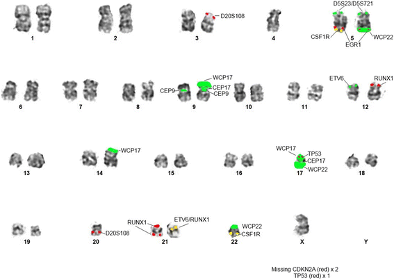 Coexistence of iAMP21 and ETV6-RUNX1 fusion in an adolescent with B cell acute lymphoblastic ...