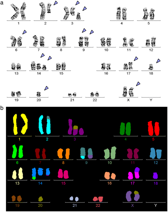 A high complex karyotype involving eleven chromosomes including three novel chromosomal ...
