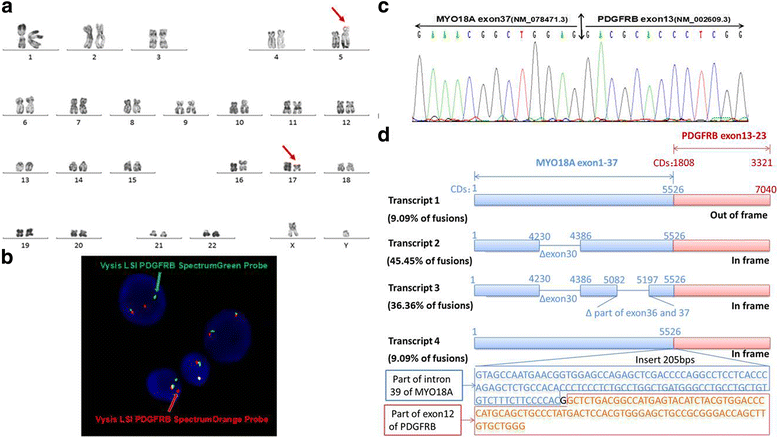 Multiple MYO18A-PDGFRB fusion transcripts in a myeloproliferative ...