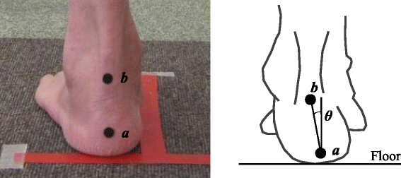Inverted Rearfoot posture in subjects with coexisting patellofemoral ...