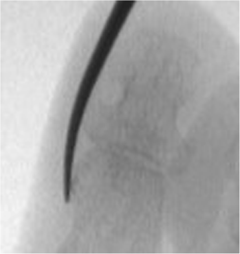 Description of the surgical technique for condylectomy with minimally ...