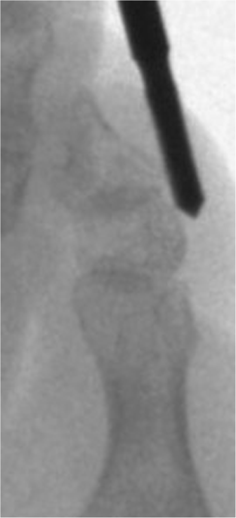 Description of the surgical technique for condylectomy with minimally ...