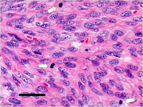 Mitotically active cellular fibroma of the ovary: a case report and ...