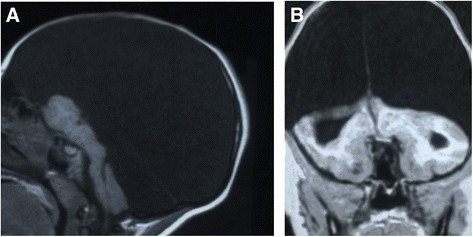 Hydranencephaly: cerebral spinal fluid instead of cerebral mantles ...