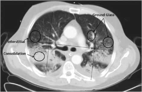 Diagnosis and management of inhalation injury: an updated review ...