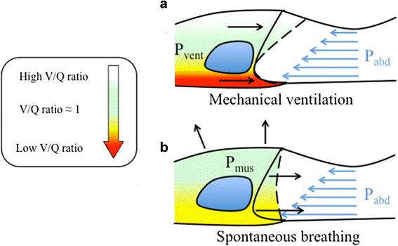 “Awake” extracorporeal membrane oxygenation (ECMO): pathophysiology ...