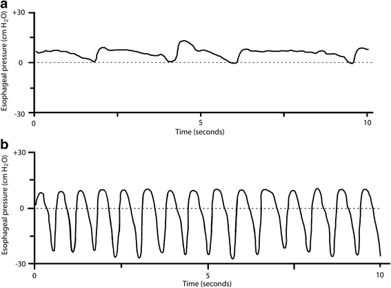 “Awake” extracorporeal membrane oxygenation (ECMO): pathophysiology ...