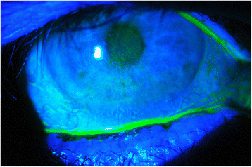 Incidence, risk factors and impact of protocolised care on exposure ...