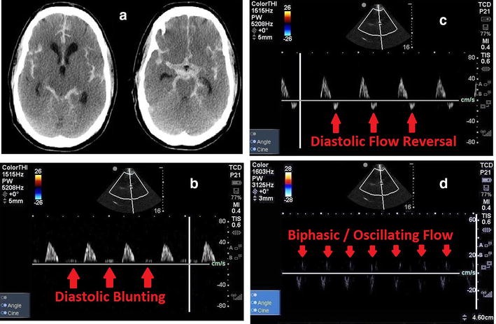 Point-of-care transcranial Doppler by intensivists | Critical ...