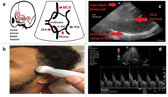 Point-of-care transcranial Doppler by intensivists | Critical ...