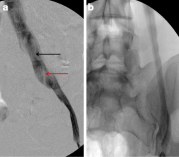 May Thurner syndrome revealed by left calf venous claudication during ...
