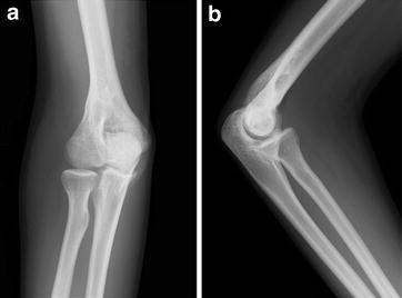 Secondary aneurysmal bone cyst in the distal humerus after resection of ...