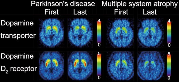 Individual time course of pre- and postsynaptic PET imaging may improve differential diagnosis ...