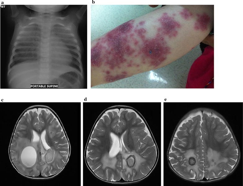 Disseminated Bacillus Calmette-Guérin (BCG) infections in infants with ...