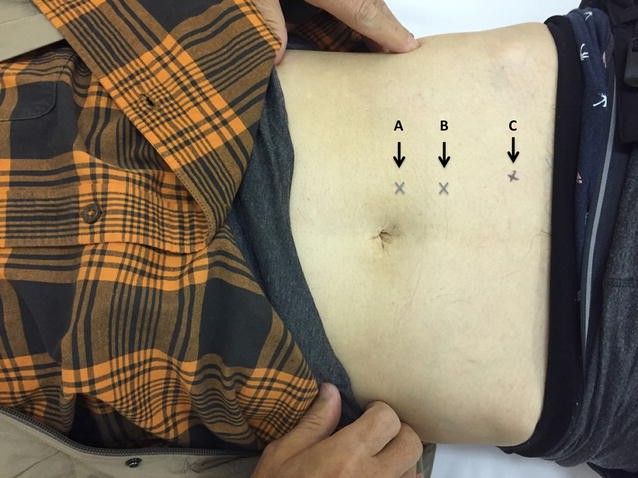 Anterior cutaneous nerve entrapment syndrome with pain present only ...
