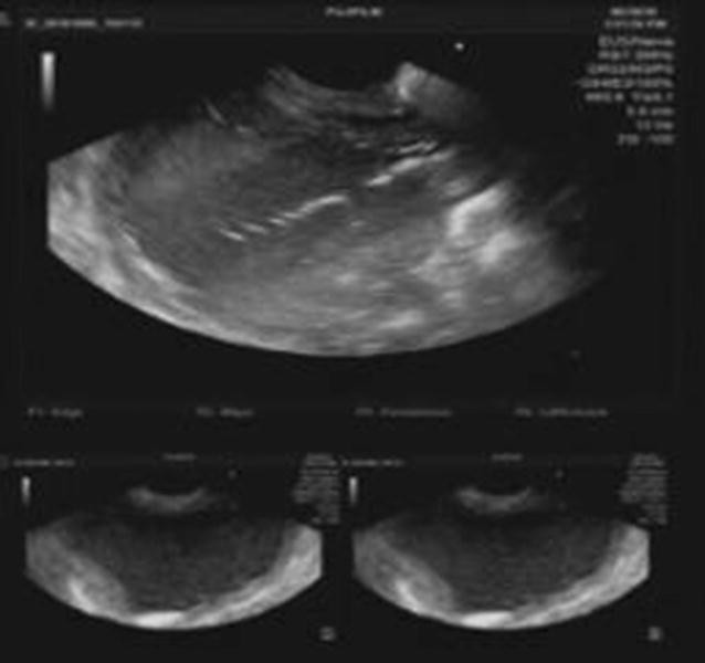 A case report of giant pancreatic pseudocyst following acute ...