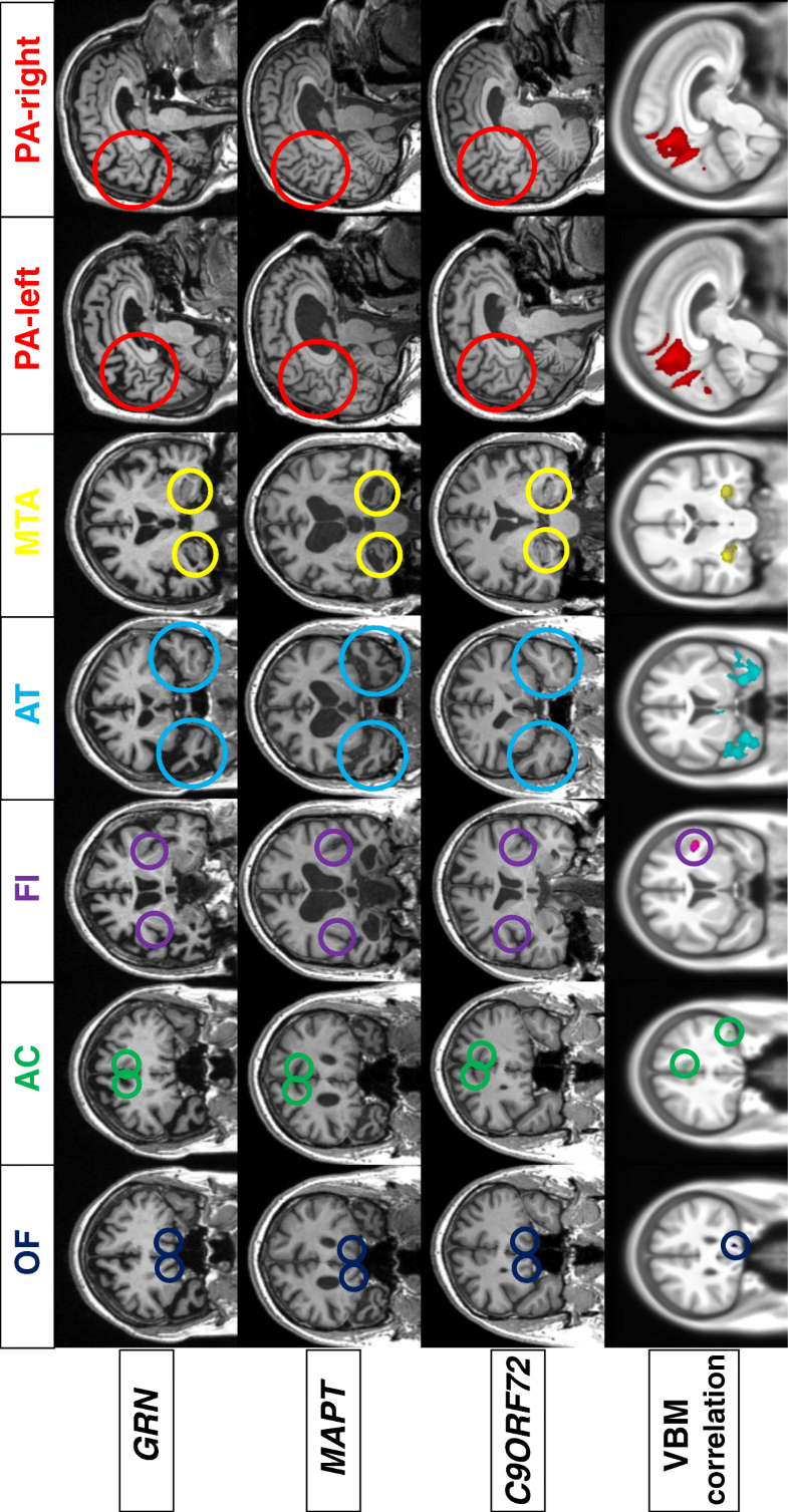 Distinct patterns of brain atrophy in Genetic Frontotemporal Dementia ...
