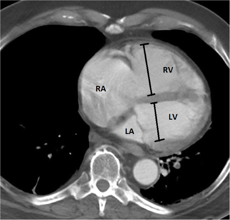 Pathophysiology of right ventricular failure in acute pulmonary ...