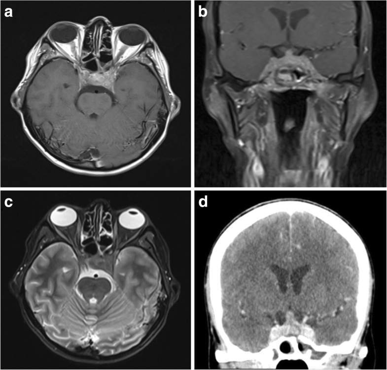 Dural masses: meningiomas and their mimics | Insights into Imaging ...