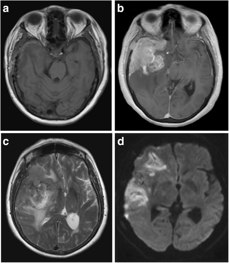 Dural masses: meningiomas and their mimics | Insights into Imaging ...