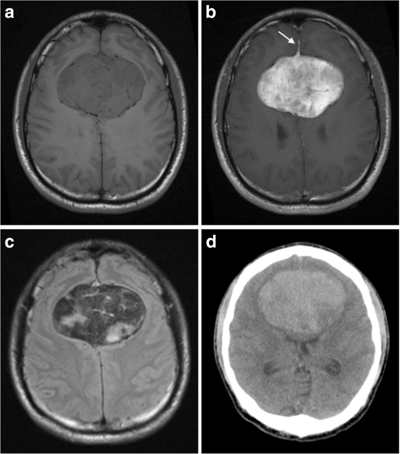 Dural masses: meningiomas and their mimics | SpringerLink