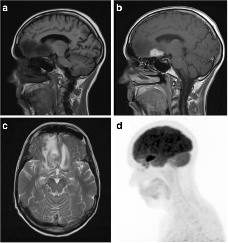Dural masses: meningiomas and their mimics | Insights into Imaging ...