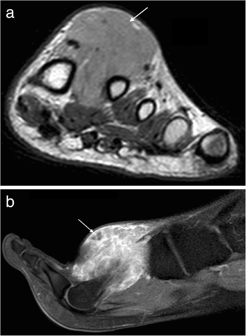 MRI imaging of soft tissue tumours of the foot and ankle | Insights ...