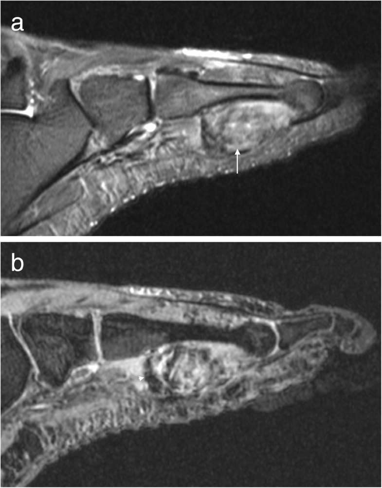 MRI imaging of soft tissue tumours of the foot and ankle | Insights ...