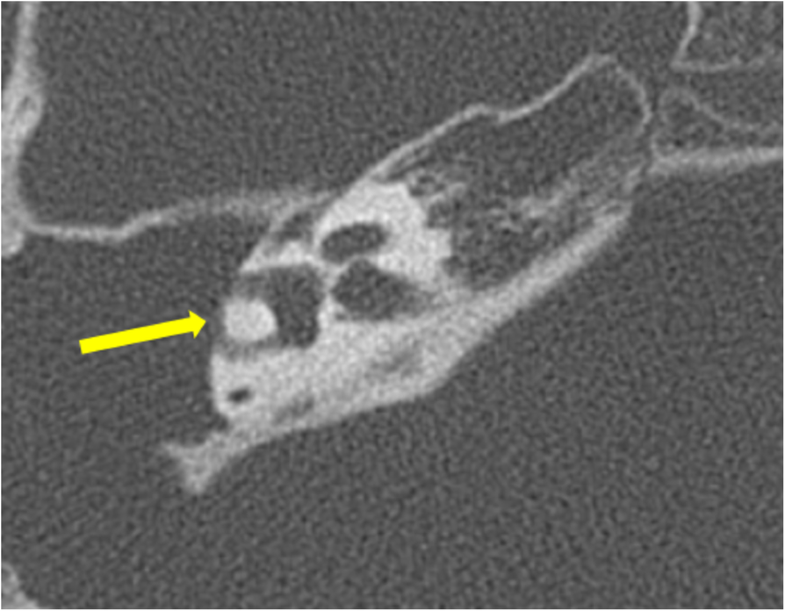 HRCT imaging of acquired cholesteatoma: a pictorial review | SpringerLink
