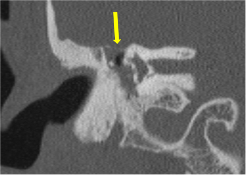 HRCT imaging of acquired cholesteatoma: a pictorial review | SpringerLink