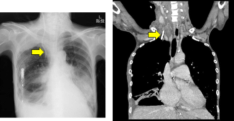 Rare central venous catheter malposition – an ultrasound-guided ...