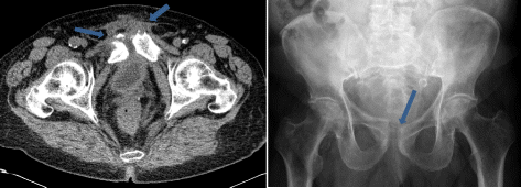 Recurrent symphysitis culminating in pelvic ring fracture after ...