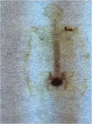 Radiation-induced chondrosarcoma of the scapula after radiotherapy for ...