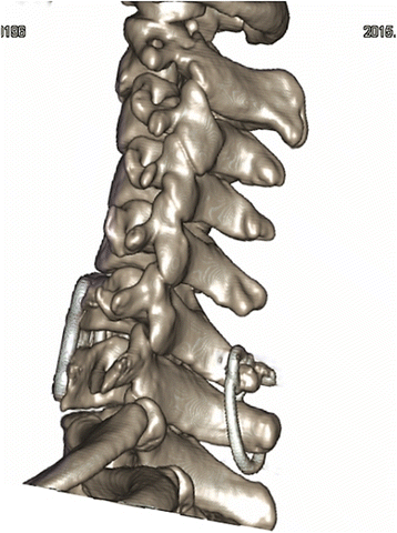 Management of irreducible unilateral facet joint dislocations in ...