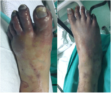 Concurrence of symmetrical peripheral gangrene and venous limb gangrene ...