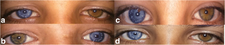 A Rare Case Of Seven Siblings With Waardenburg Syndrome A Case Report