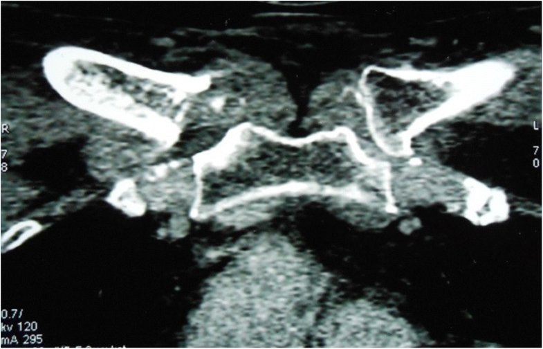 Bilateral septic arthritis of the sternoclavicular joint complicating ...