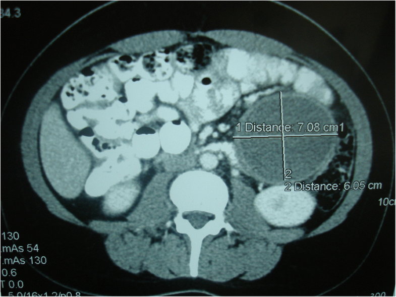Ideal treatment strategy for chylous mesenteric cyst: a case report ...