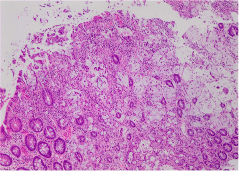 Goblet cell carcinoid of the appendix – diagnostic challenges and ...