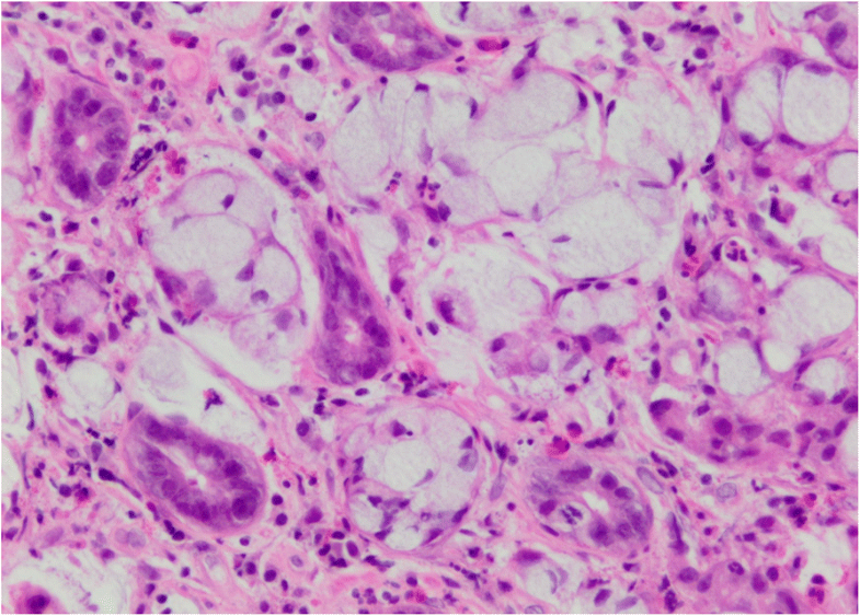Goblet cell carcinoid of the appendix – diagnostic challenges and ...