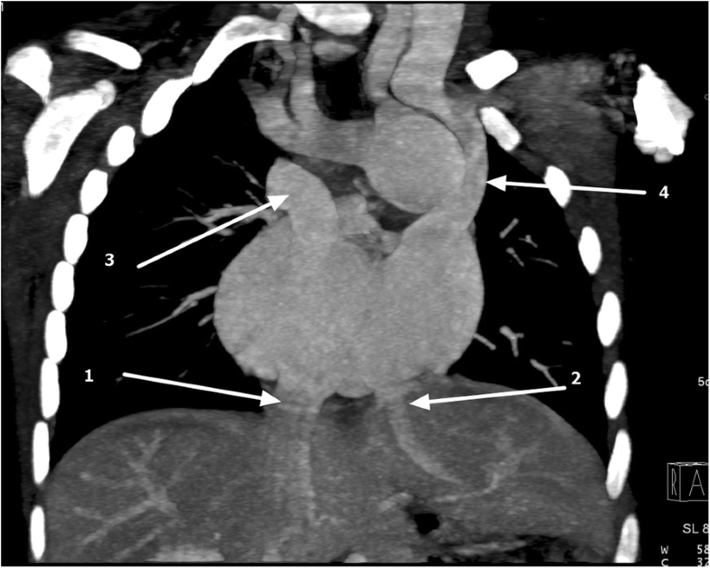 Complex congenital cardiac anomalies in the setting of right isomerism ...