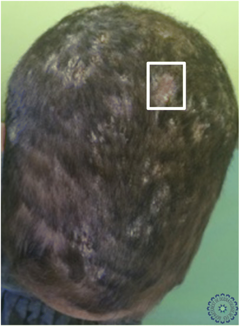 A prospective study of tinea capitis in children: making the diagnosis ...